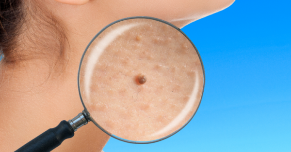 Check What Kind of Neck Skin Tag is Abnormal and Cancerous | Ratchasima ...