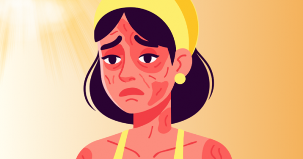 Did You Know Winter Sunlight Can Be Twice As Dangerous Ratchasima